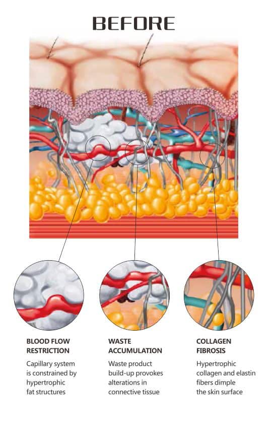Buy Professional Acoustic Wave Therapy Device For Cellulite At ...