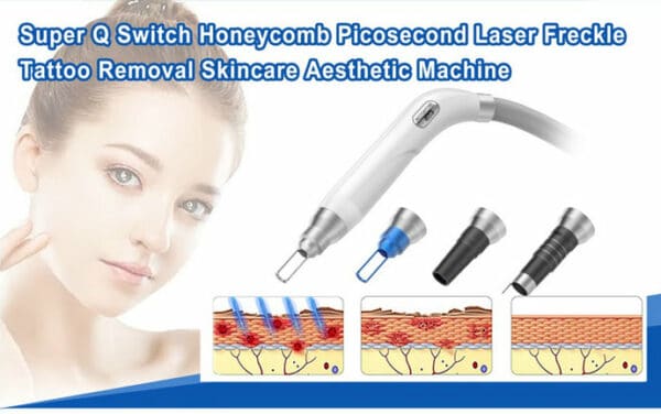 Tratamiento con láser Q Switch: Lo que necesita saber - OSANO